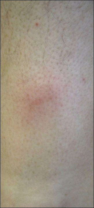 Azathioprine Hypersensitivity Presenting as Neutrophilic Dermatosis and ...