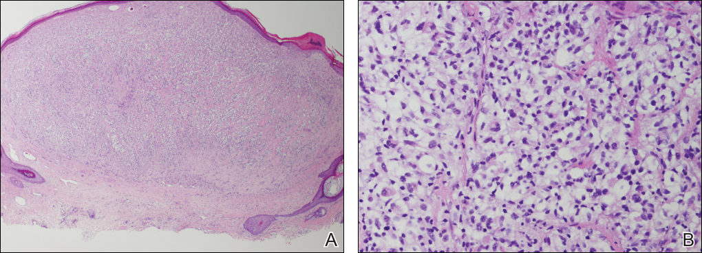 Firm Pink Nodule on the Scalp | MDedge Dermatology