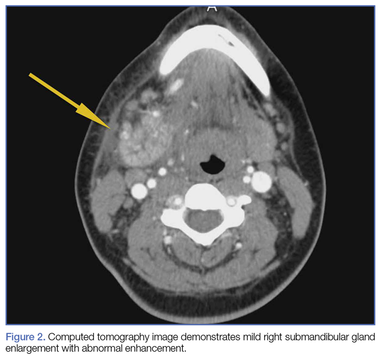 Acute Submandibular Sialadenitis | MDedge Emergency Medicine Acute Submandibular Sialadenitis | MDedge Emergency Medicine