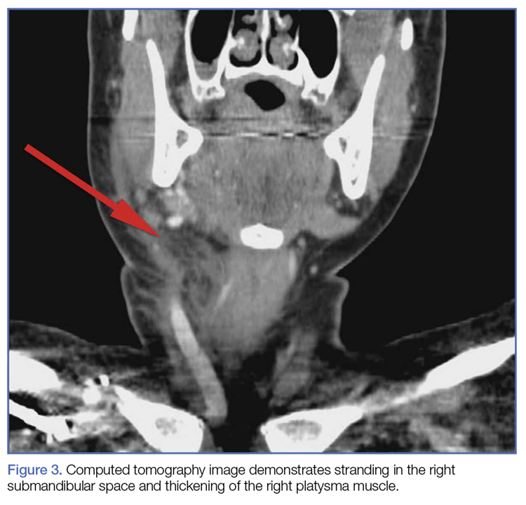 Acute Submandibular Sialadenitis | MDedge Emergency Medicine Acute Submandibular Sialadenitis | MDedge Emergency Medicine
