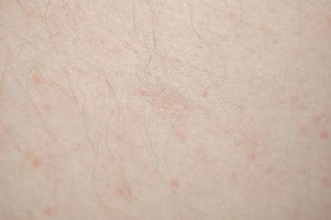 Macular Atrophy Skin