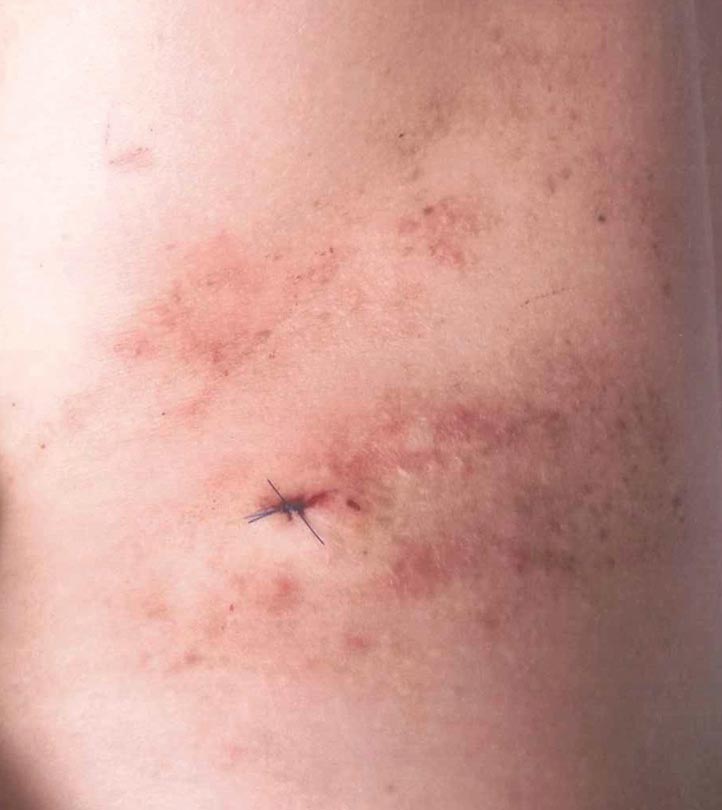 Clustered Vesicles in a Blaschkoid Pattern | MDedge Dermatology