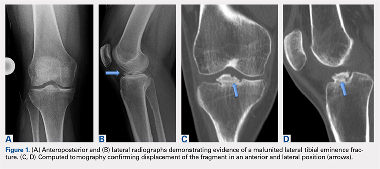 Intercondylar Eminence Of Tibia