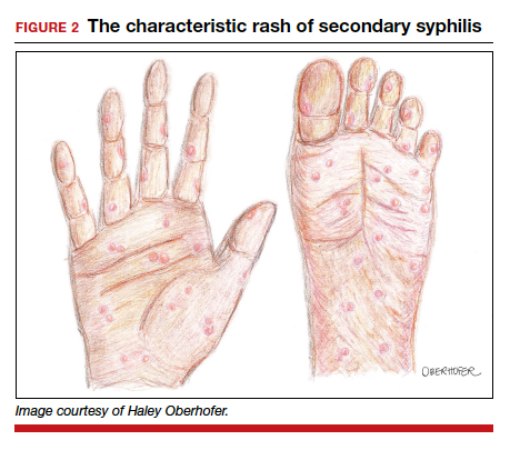 Syphilis: Cutting risk through primary prevention and prenatal ...