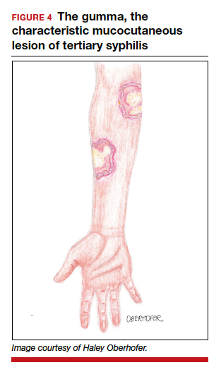 Syphilis: Cutting risk through primary prevention and prenatal ...