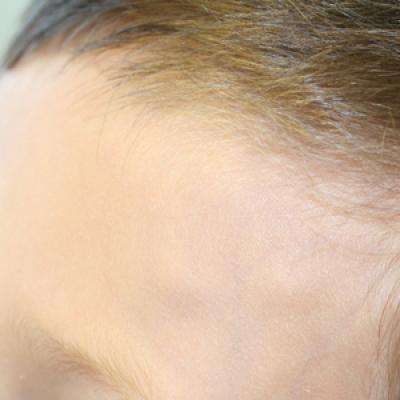 Granuloma Annulare Presenting as Firm Nodules on the Forehead and Scalp ...