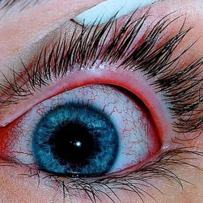 Patients with AD should routinely be asked about conjunctivitis ...
