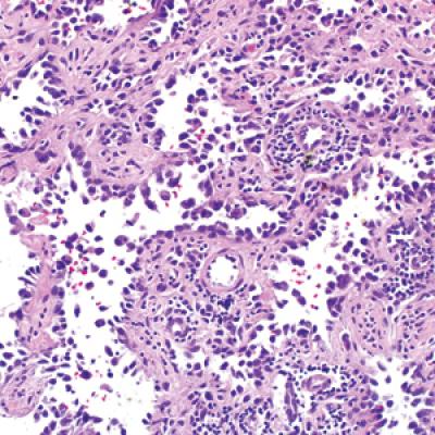 Gone Fishing: A Unique Histologic Pattern in Cutaneous Angiosarcoma ...