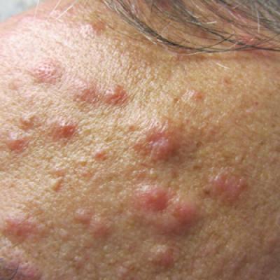Eosinophilic Folliculitis Face Pustular Facial Eruptions Clinical