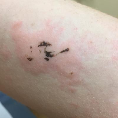 Lesions With a Distinct Black Pigment | MDedge Dermatology