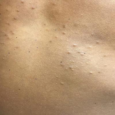 Eruptive Vellus Hair Cyst Vellus Hair (Peach Fuzz): What It Is,