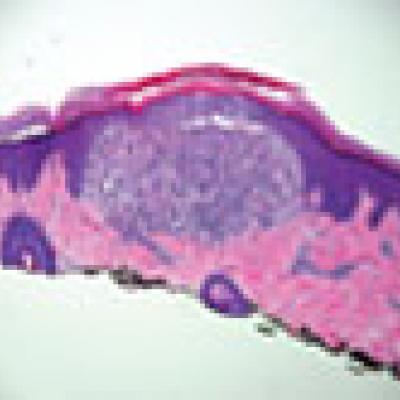 Lichen Nitidus | MDedge Dermatology
