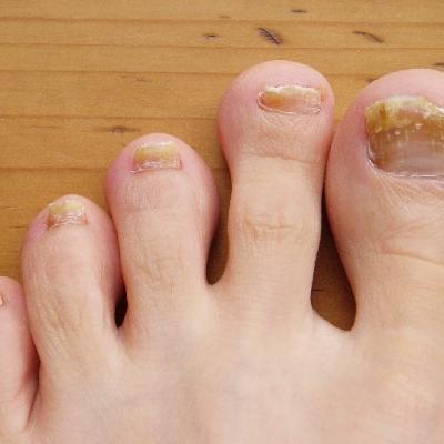 Onychomycosis: Not just for adults | MDedge Pediatrics