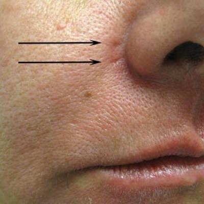 Linear Scarring Following Treatment With a 595-nm Pulsed Dye Laser ...