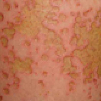 Sulfur Spring Dermatitis | MDedge Dermatology