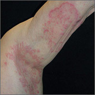 Pruritic rash in armpit MDedge Family Medicine