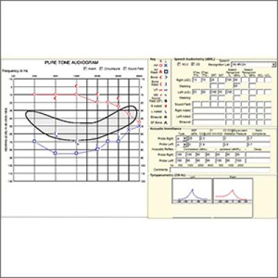 Acute hearing loss, tinnitus, and fullness in the left ear • Weber test ...