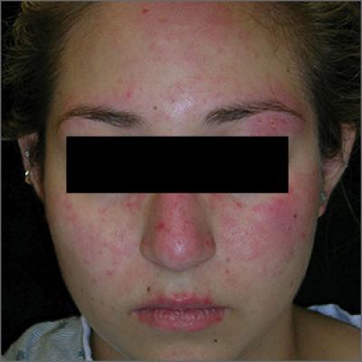 Rash on face, chest, upper arms, and thighs | MDedge Family Medicine