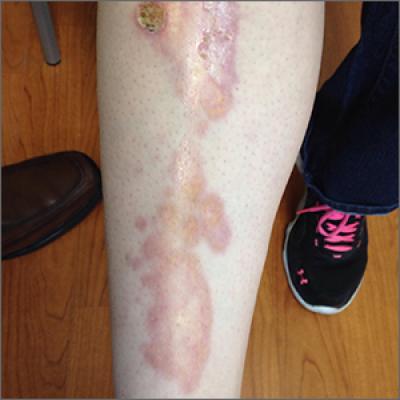 Leg rash | MDedge Family Medicine