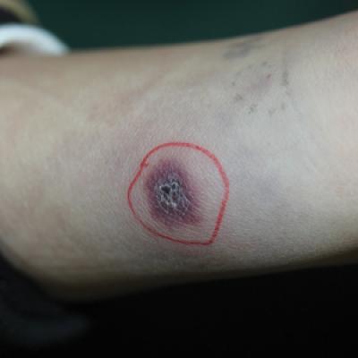 Systemic Epstein-Barr Virus–Positive T-cell Lymphoma of Childhood ...