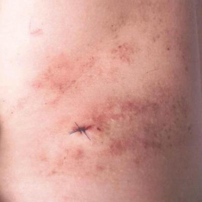 Clustered Vesicles in a Blaschkoid Pattern | MDedge Dermatology