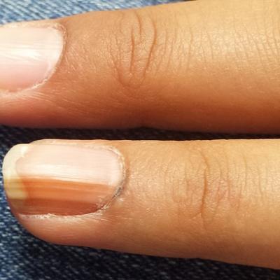 Longitudinal Melanonychia Pictures Pigmented Nail Disorders