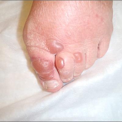Blisters on toes MDedge Family Medicine