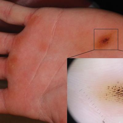 Brown-Black Punctate Macule on the Left Palm | MDedge Dermatology