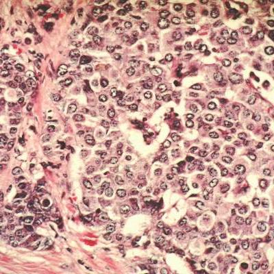 Breast cancer treatment linked to mild systolic dysfunction | CHEST ...