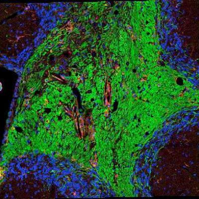 Evidence points to early brain cell death as catalyst for MS ...