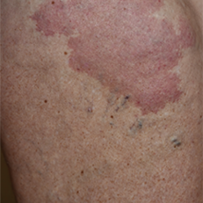 Growing Subcutaneous Mass on the Thigh | MDedge Dermatology